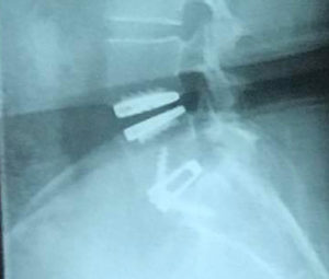 M6 Hybrid ADR Fusion Surgery - M6 Disc Replacement